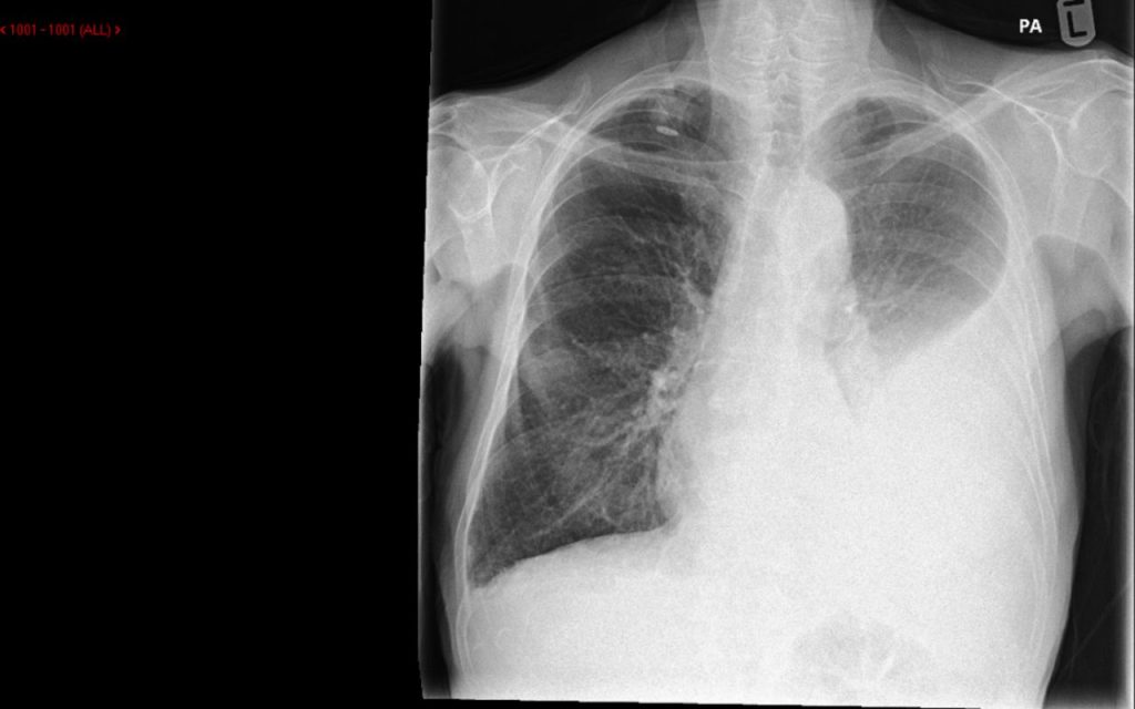 Pleural effusion (Fluid in the pleural space) - Sleep and Lung Care