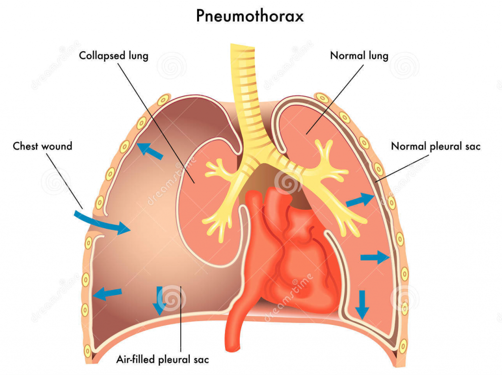 Pneumothorax – Sleep and Lung Care