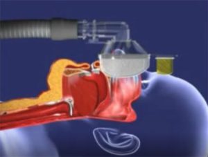 What is CPAP and how does CPAP work? – Sleep and Lung Care